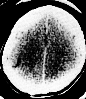CT for the brain