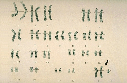 My Klinefelter's Syndrome Page